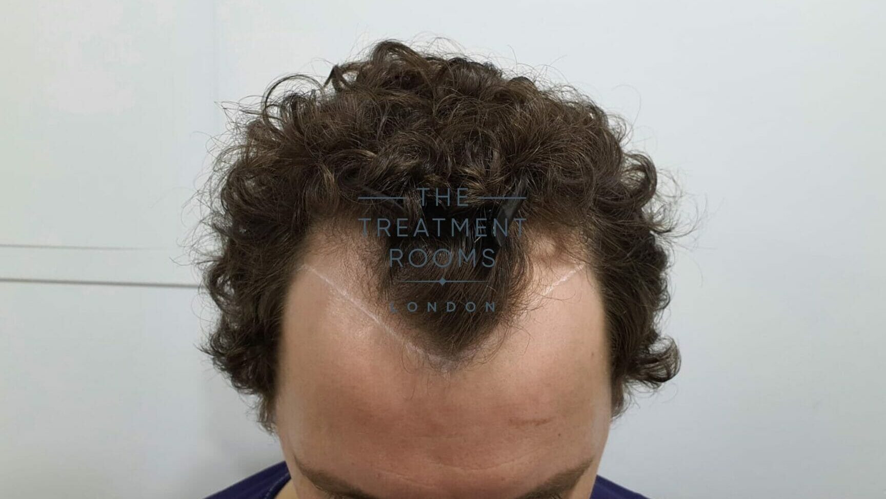 The Spiritual Meaning of Widow's Peak: Unveiling the Mystical Symbolism ... The Spiritual Meaning of Widow's Peak: Unveiling the Mystical Symbolism ...